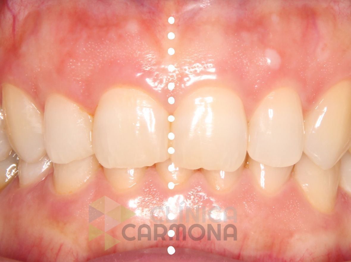 Línea media dental - Clínica Dental Carmona