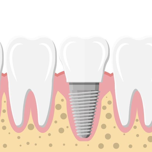 Implante dental = diente natural - Clínica Dental Carmona
